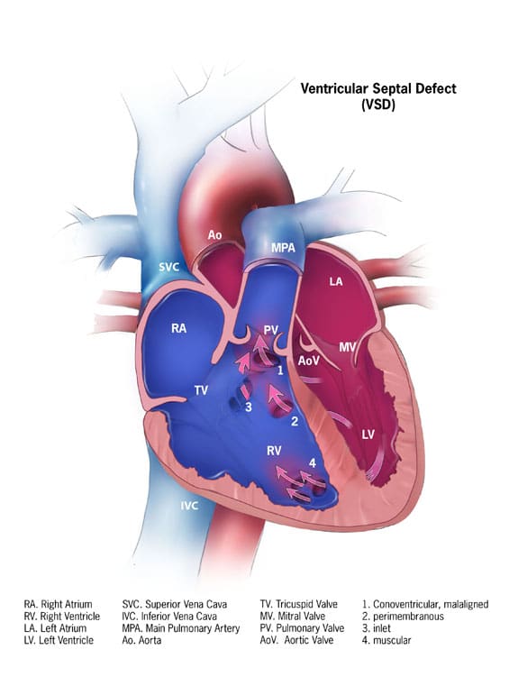 Ventricular Septal Defect - NURSING.com