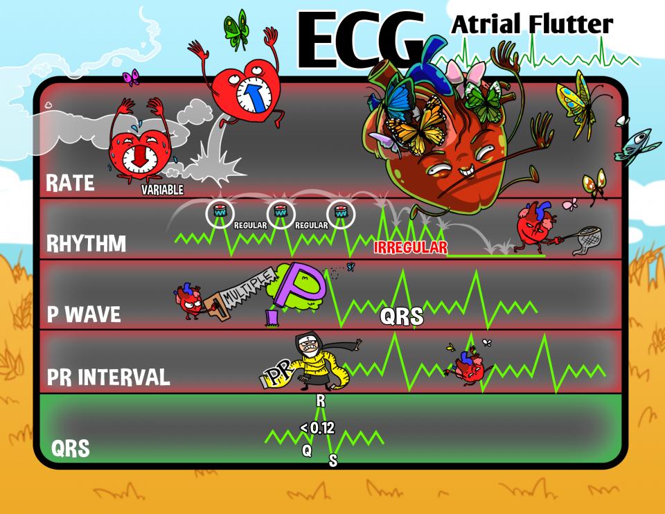 ECG: Atrial Flutter - NURSING.com